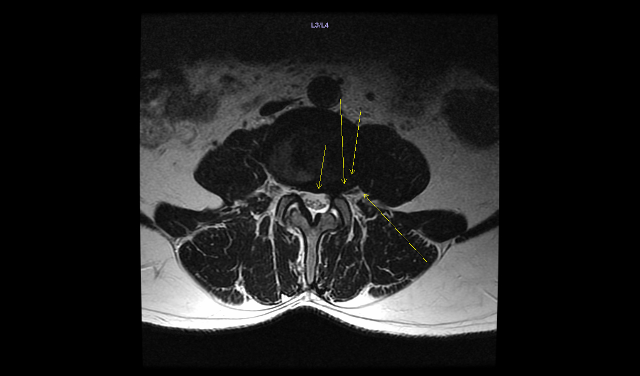 MRI Lumbar Spine | GWIC