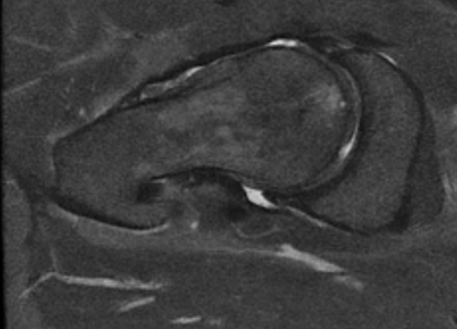 MRI Right Hip Case Study | Greater Waterbury Imaging Center