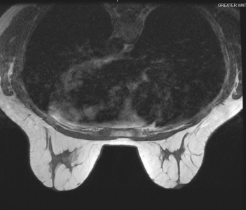 MR BILATERAL BREASTS WITH AND WITHOUT IV CONTRAST - Greater Waterbury ...