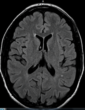 Using MRI to Diagnose and Monitor Alzheimer’s Disease and Dementia ...
