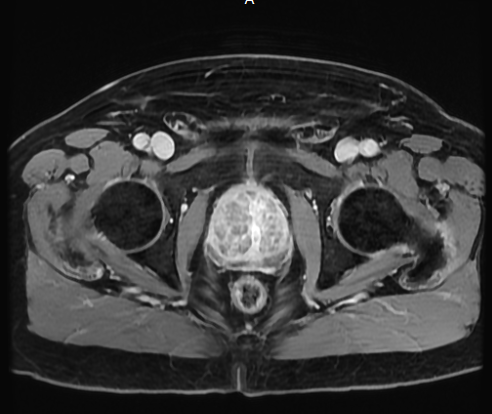 MR PELVIS WITH AND WITHOUT CONTRAST - Greater Waterbury Imaging Center