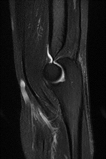 MR LEFT ELBOW - Greater Waterbury Imaging Center